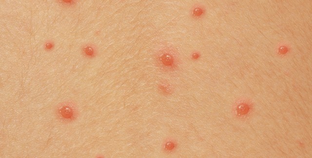 How to spot the signs of meningitis and relieve a stiff neck | Smart Tips